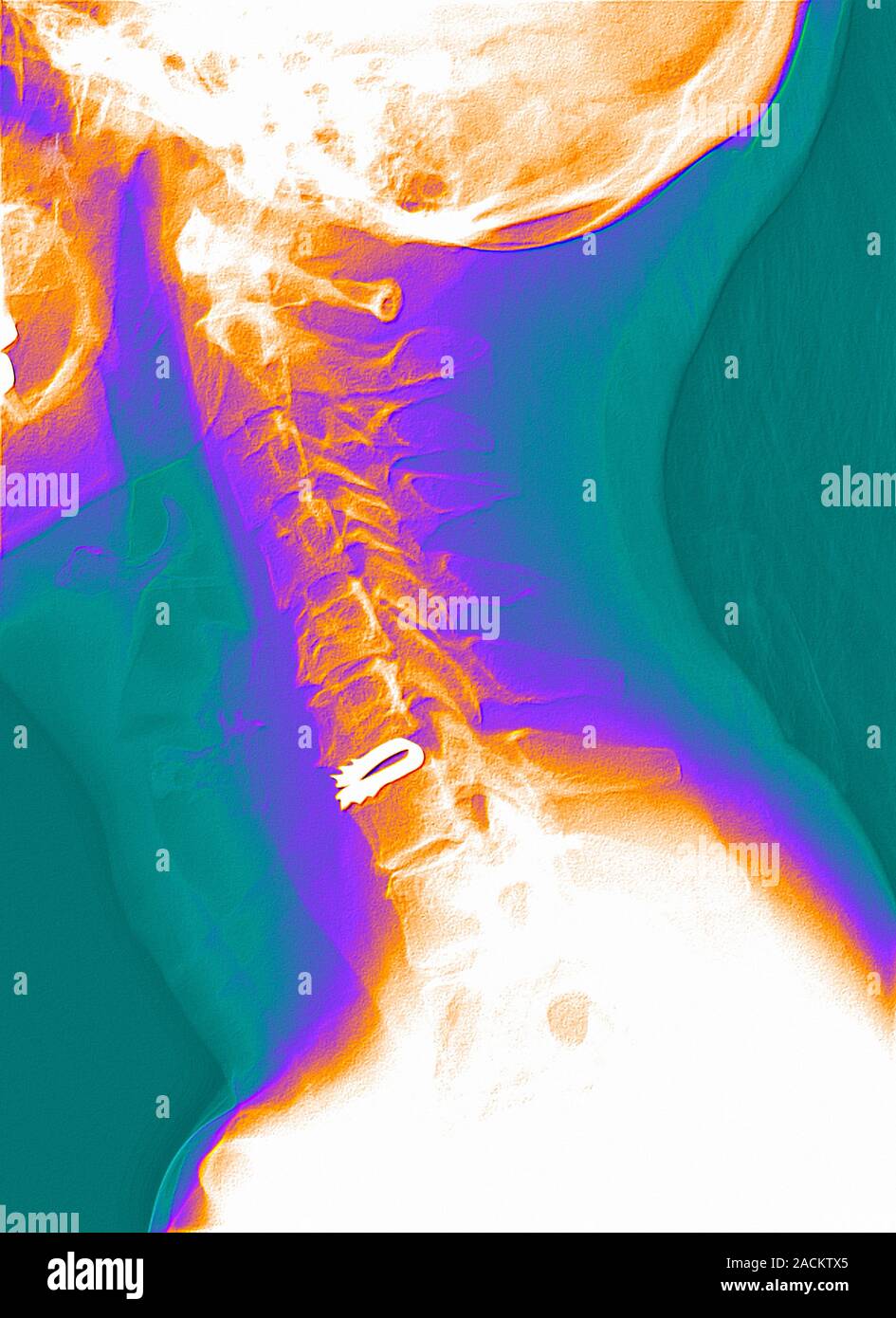 False-colour x-ray (side view ) of the cervical spine showing an ...