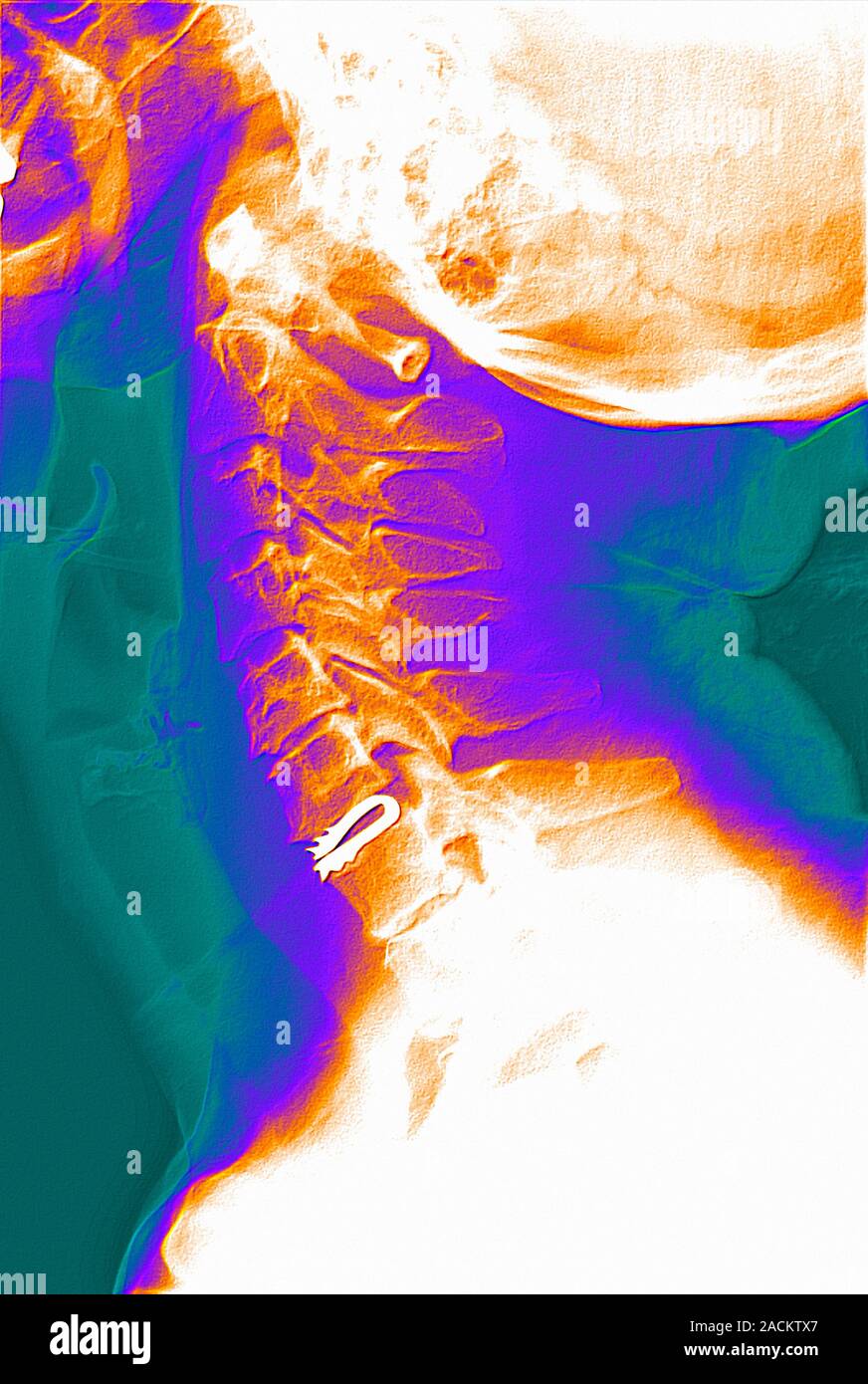 Intervertebral Disc Prosthesis Intervertebral Disc Prosthesis