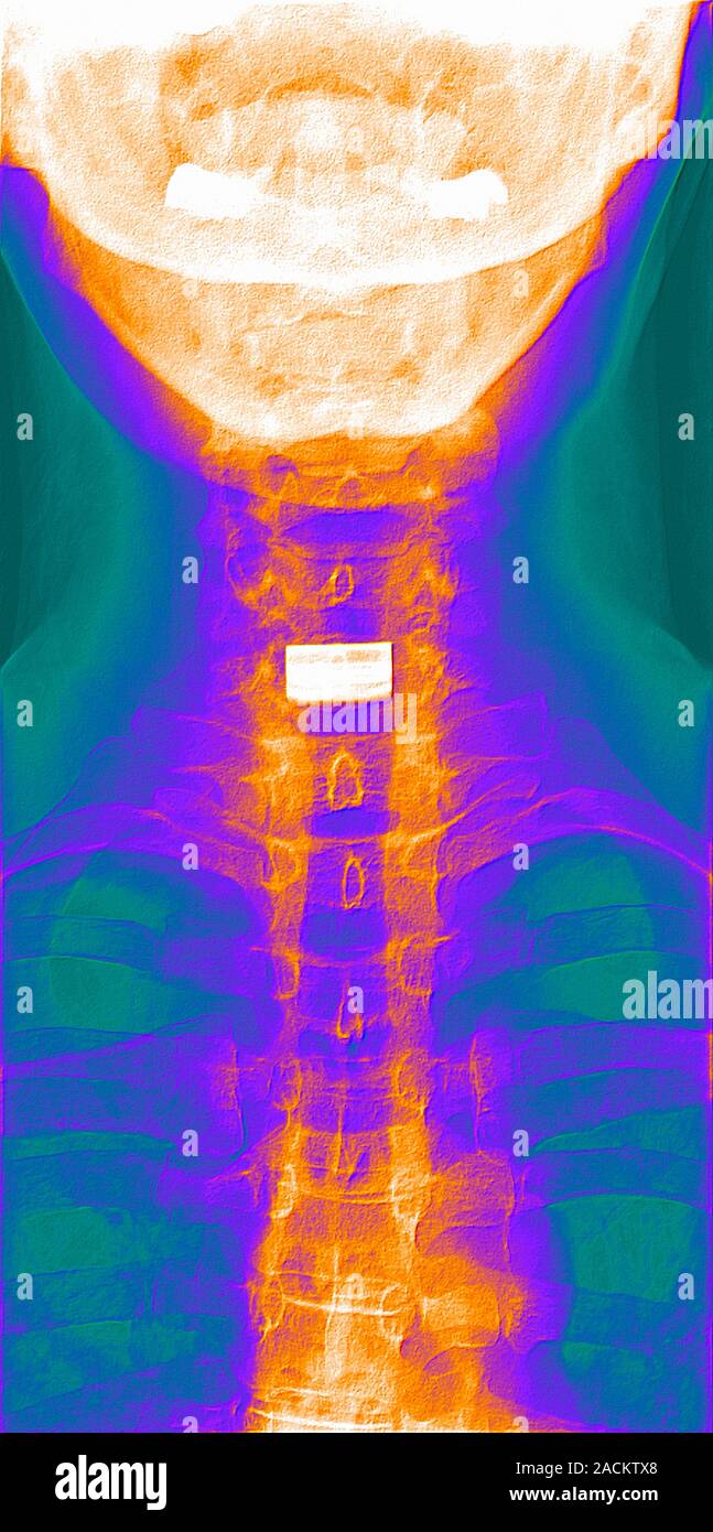 False-colour x-ray (frontal view ) of the cervical spine showing an ...