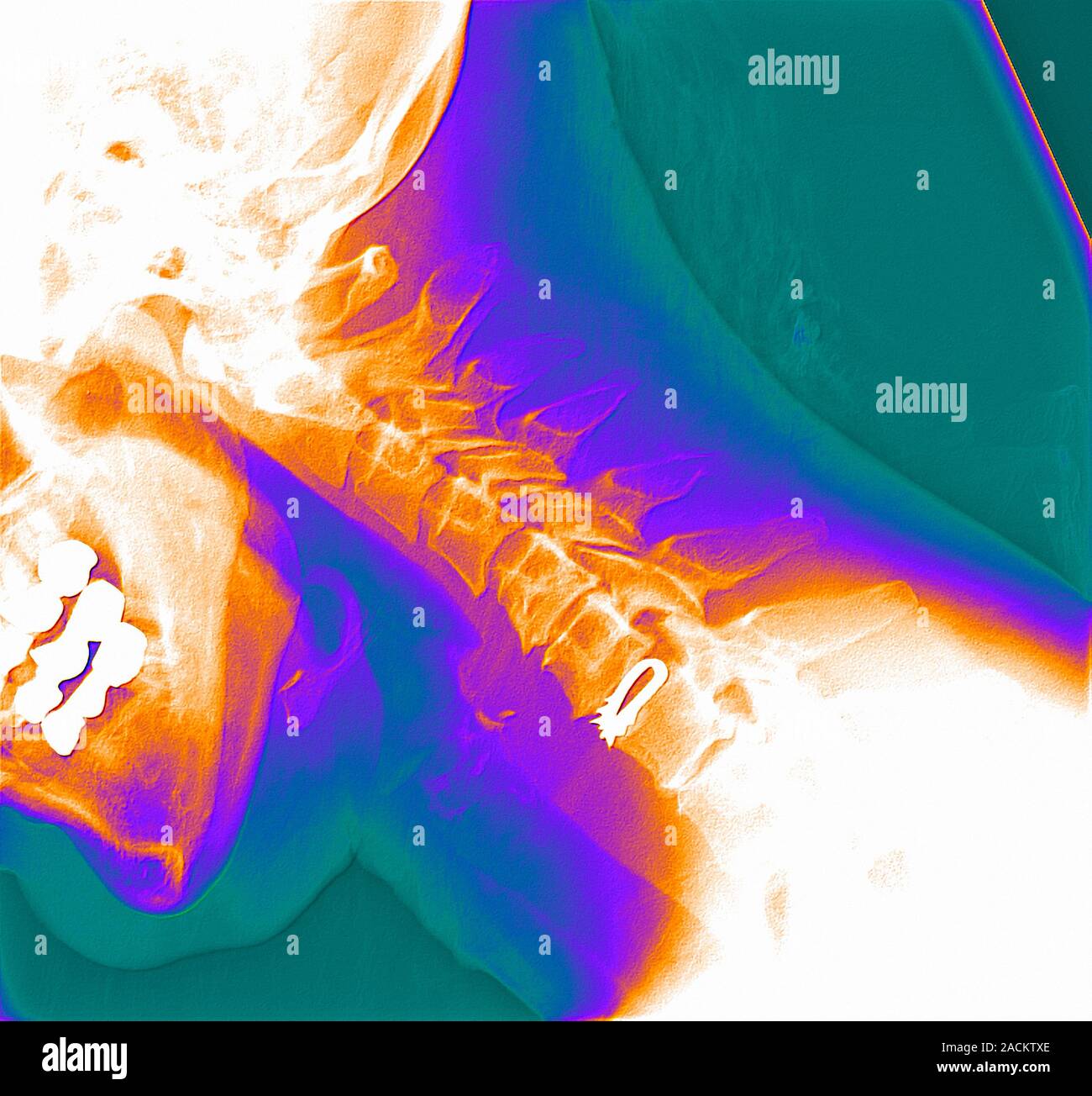 False-colour x-ray (antiflexion side view ) of the cervical spine ...