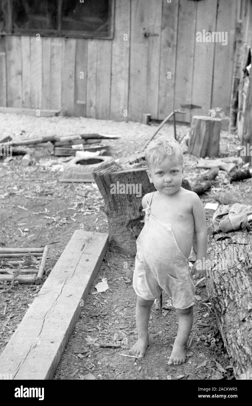 Child with rickets. Sharecropper's child suffering from rickets and ...
