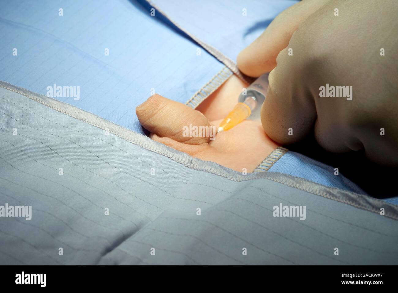 Tight foreskin corrective surgery. Surgeon operating on the foreskin of ...