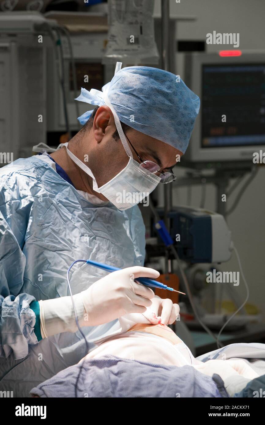 Surgeon performing surgery to remove (excise) a lesion in the shoulder ...