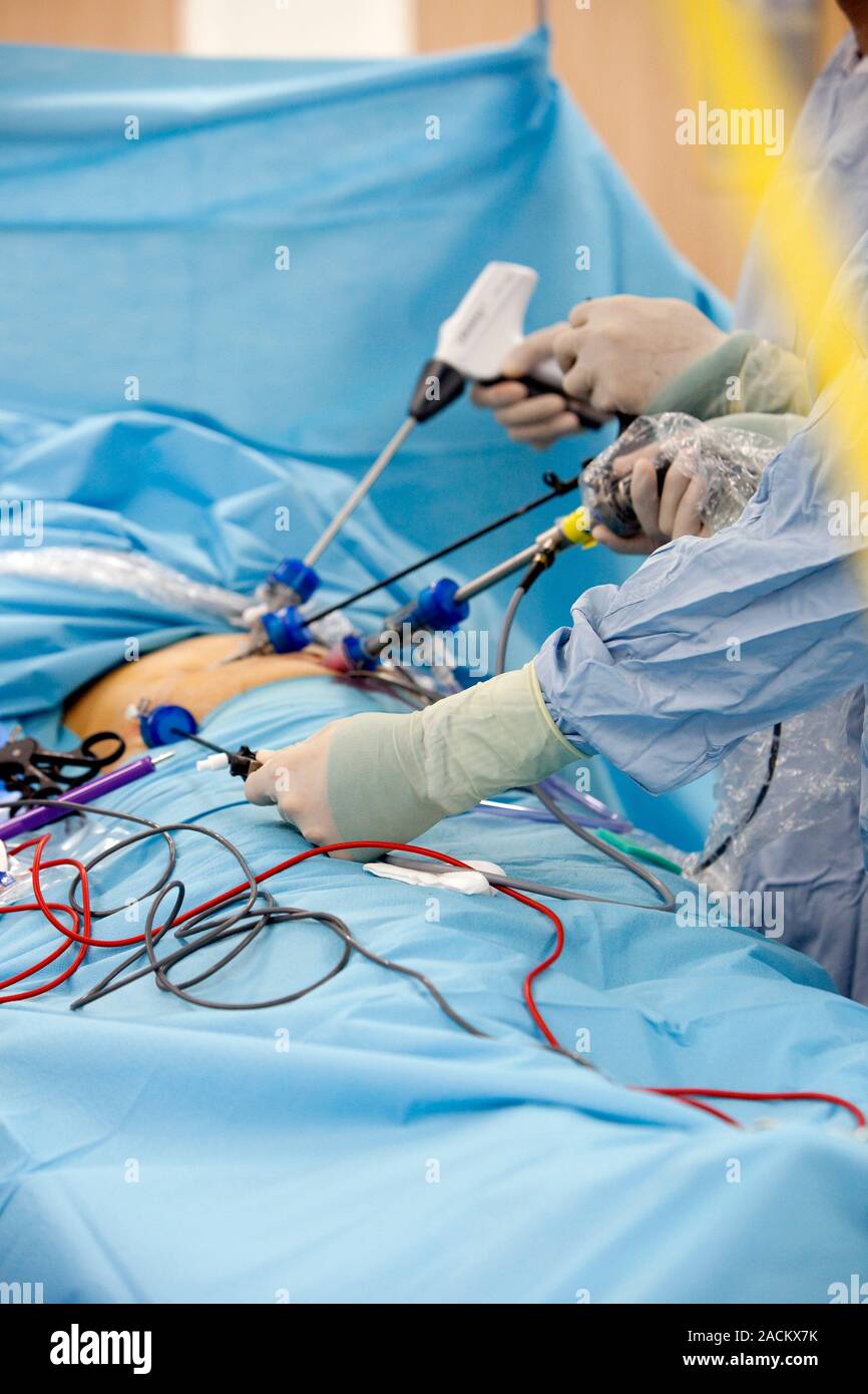 Surgeon's gloved hands using laparoscopes (endoscopes) to remove the ...