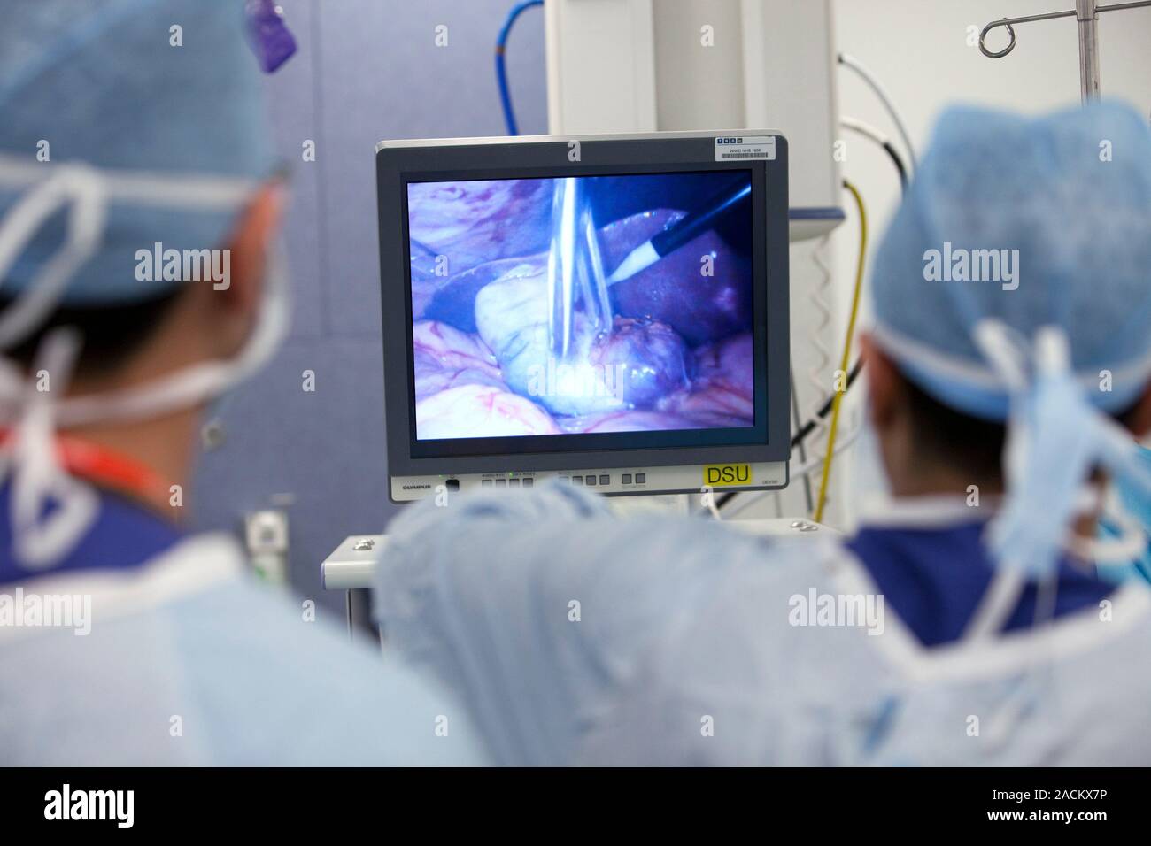 Monitor showing the use of laparoscopes (endoscopes) to remove the gall ...