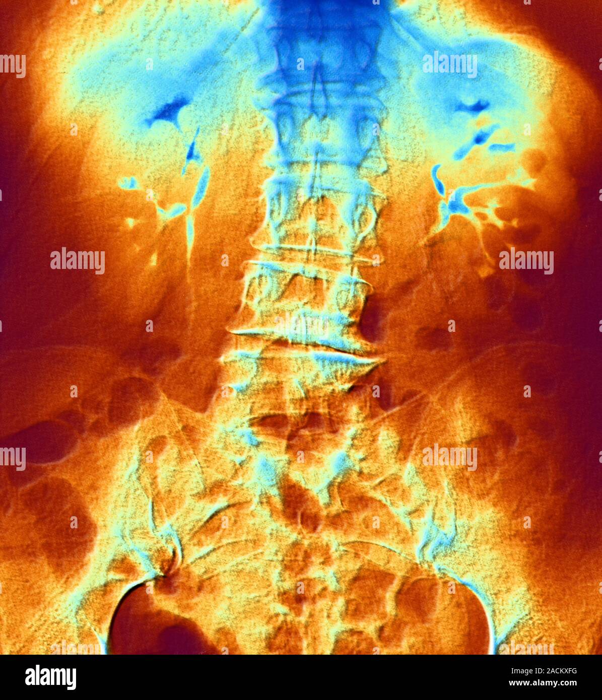 Diseased spine. Frontal coloured X-ray of the lumbar spine of a 60 year ...