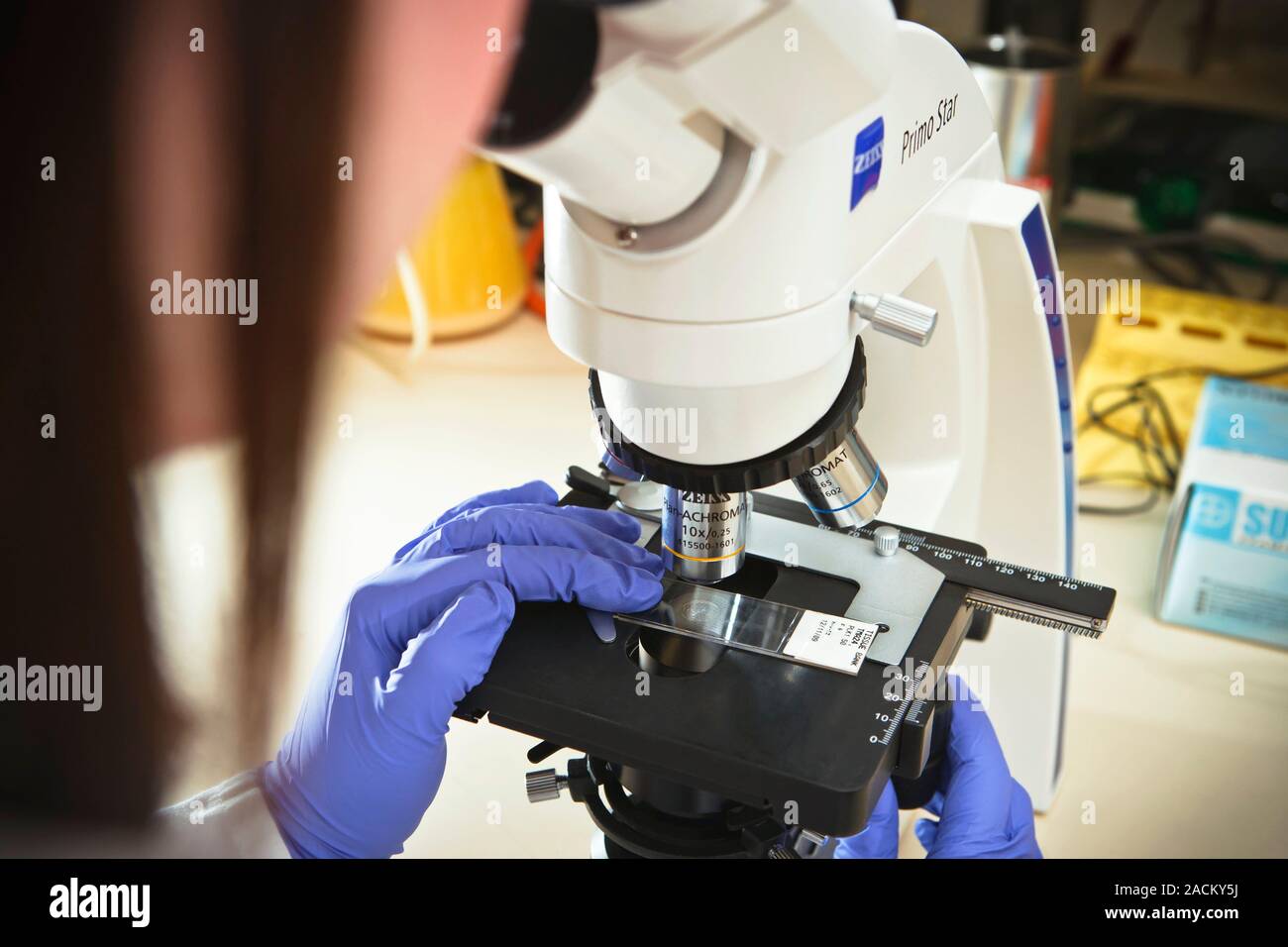 Cancer research laboratory. Researcher looking at a specimen under a ...