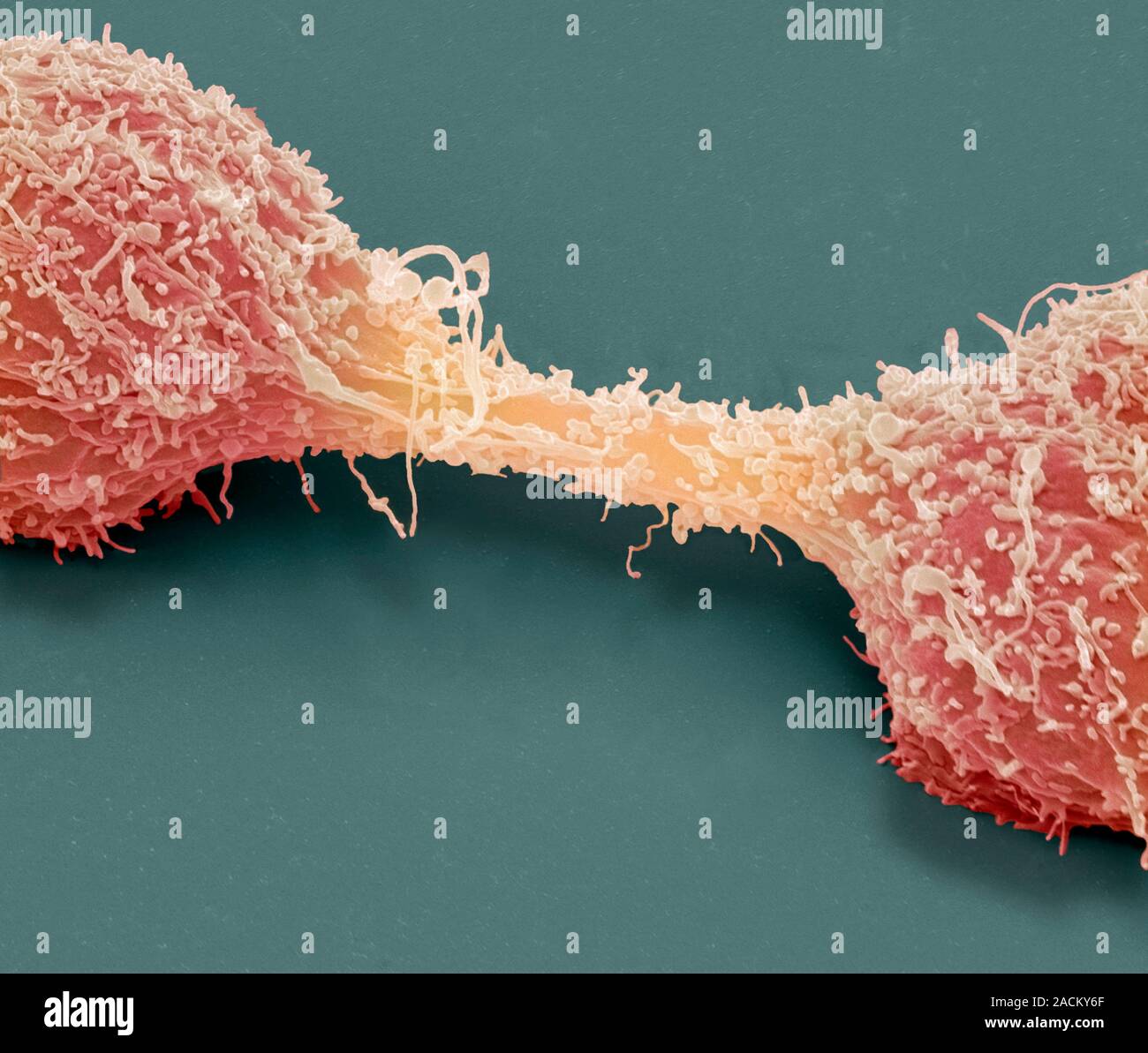 Dividing brain cancer cells. Coloured scanning electron micrograph (SEM ...