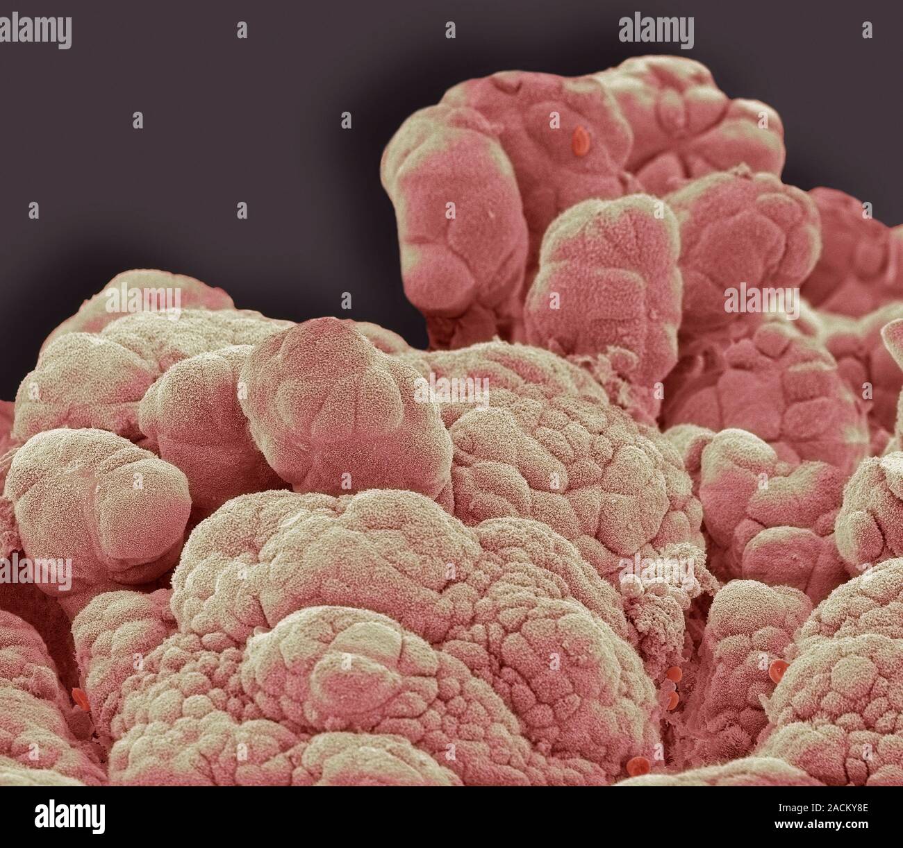 Intestinal papilloma. Coloured scanning electron micrograph (SEM) of a ...