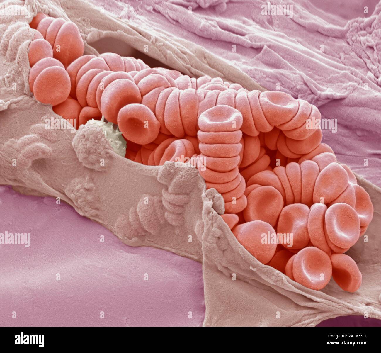 Ruptured venule. Coloured scanning electron micrograph (SEM) showing ...