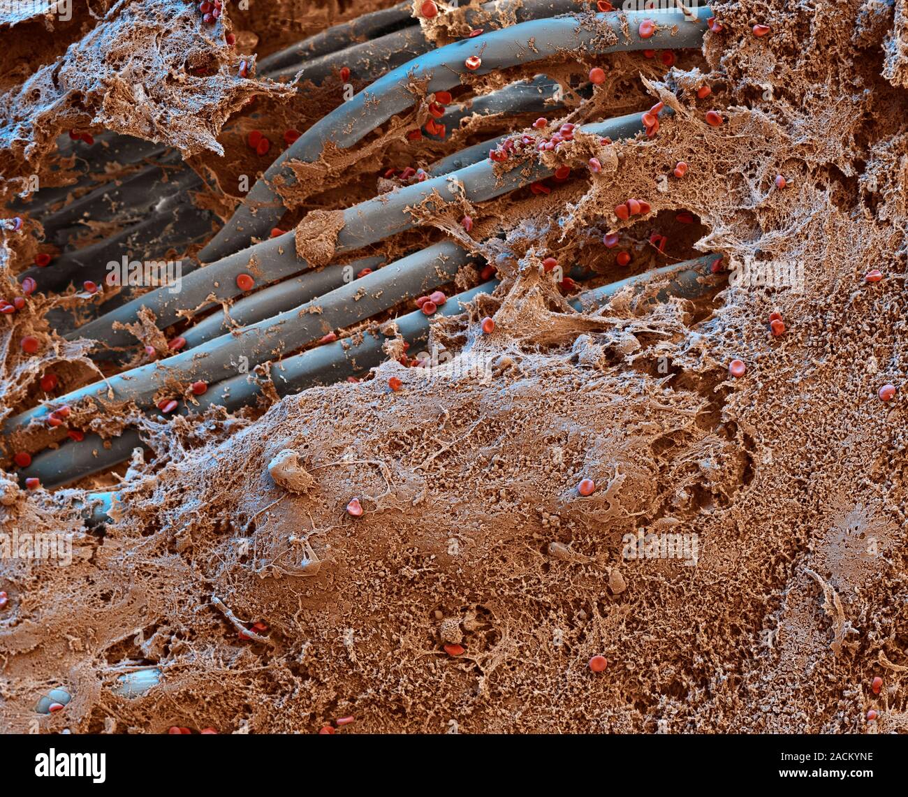 Aortic repair. Coloured scanning electron micrograph (SEM) of a stent ...