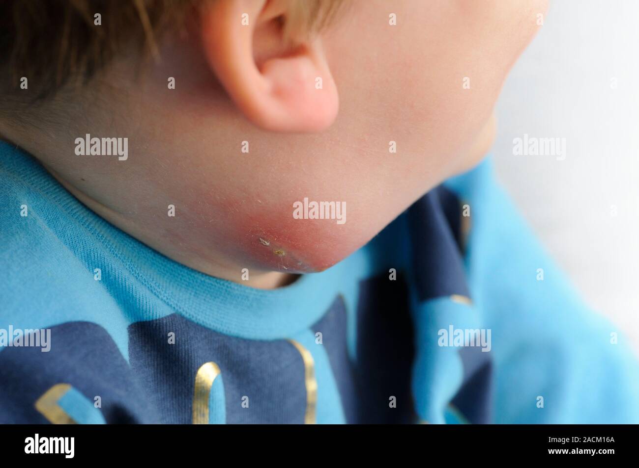 Not for use in Television Not for use in Television Red swelling on the ...