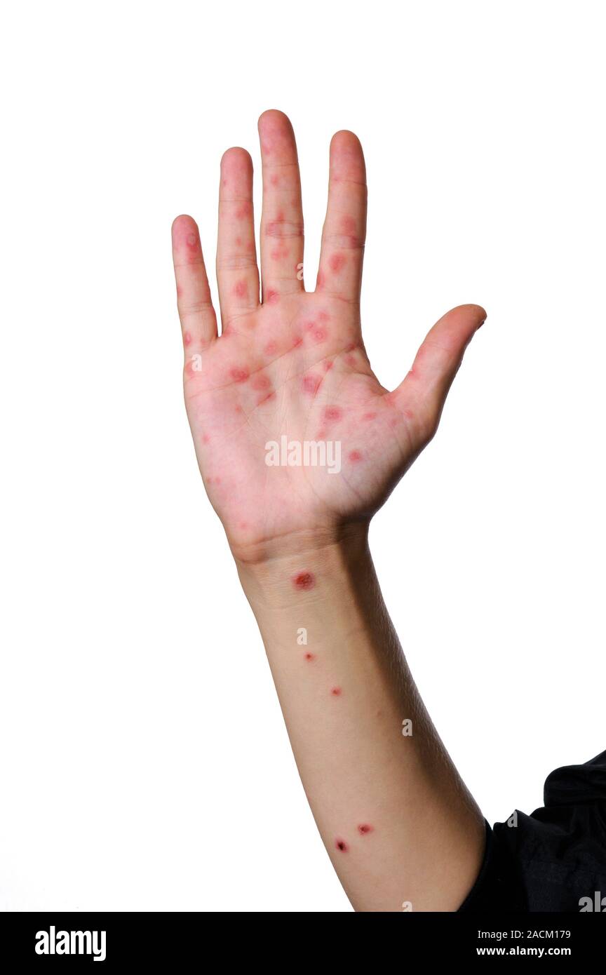 Not for use in Television Not for use in Television Rash of lesions ...