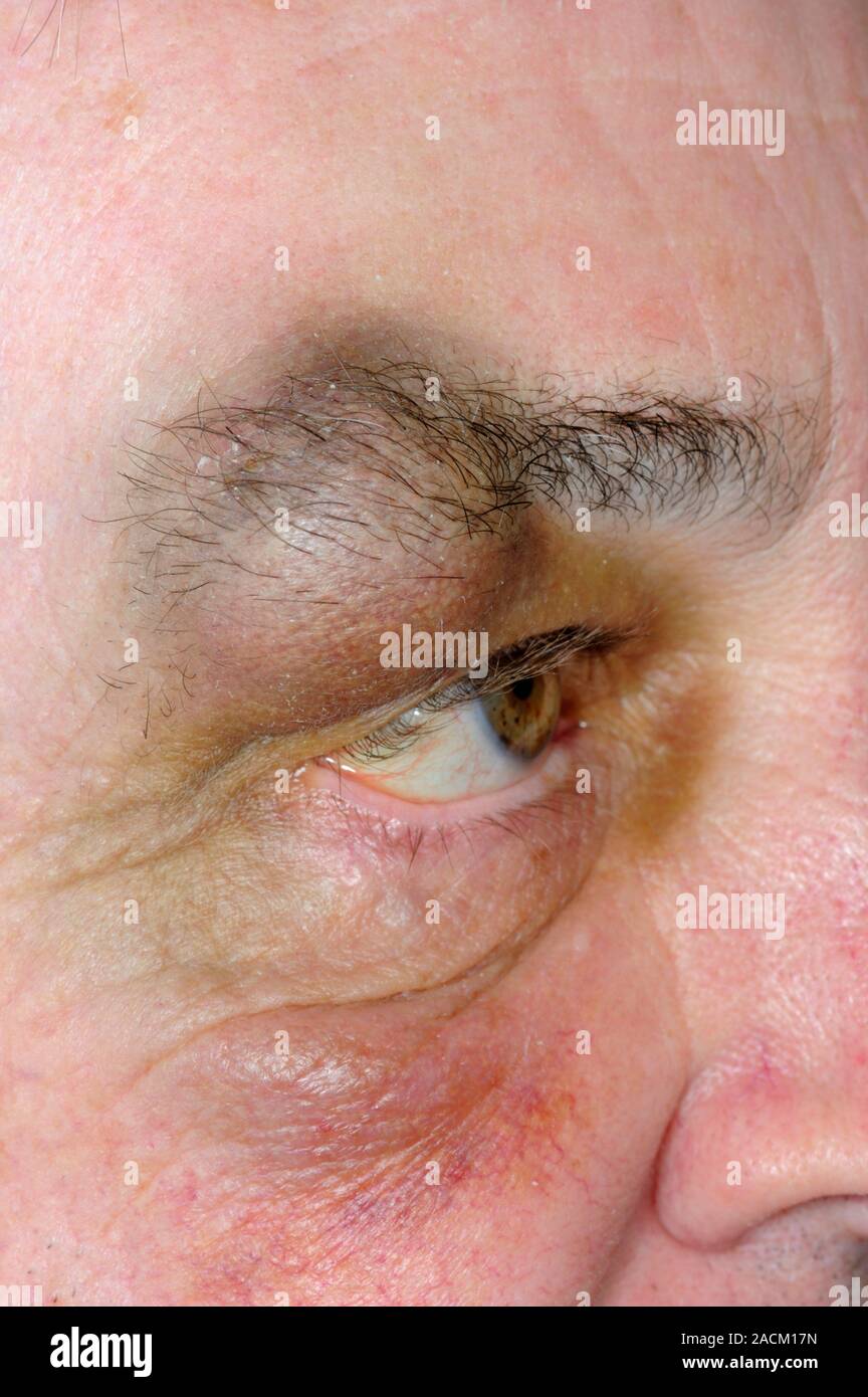 Not for use in Television Not for use in Television Black eye caused by ...