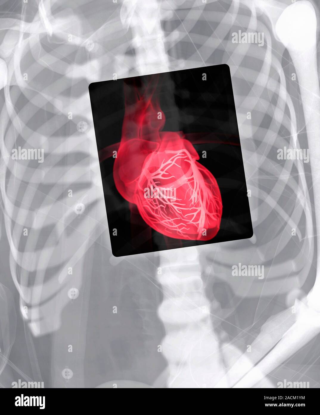 Heart, conceptual X-ray montage. The coloured heart X-ray has been ...