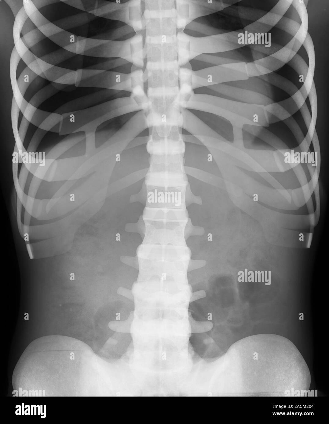 Human thorax, X-ray. The bones of the rib cage, the vertebrae of the ...