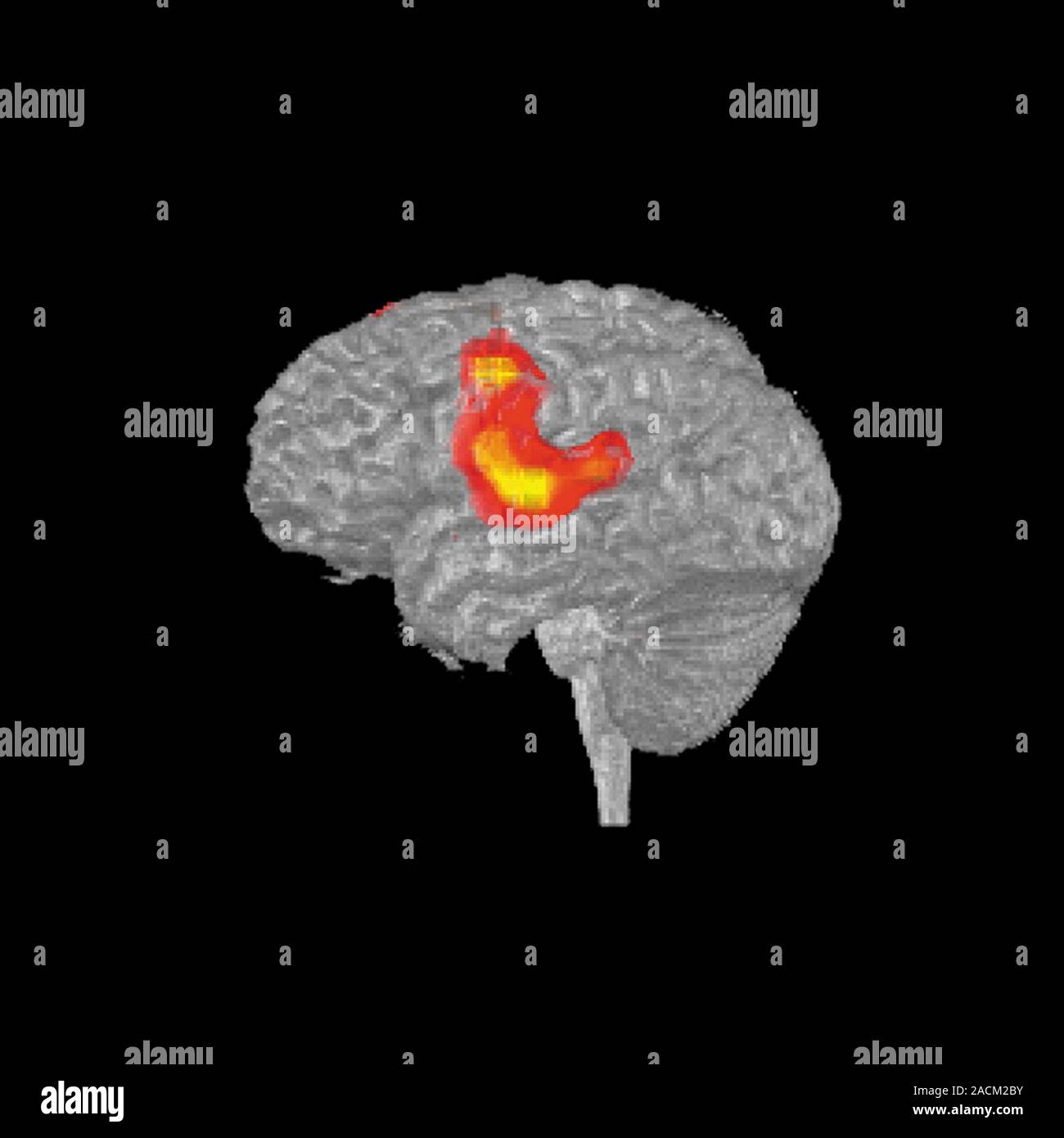 Brain activity during speech. Coloured positron emission tomography ...