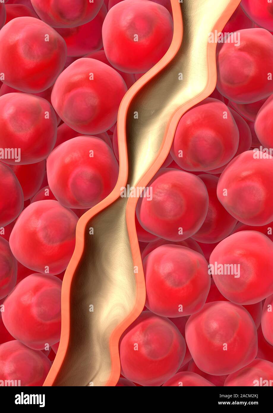 Urethral stricture. Computer artwork of a narrowing of the urethra ...