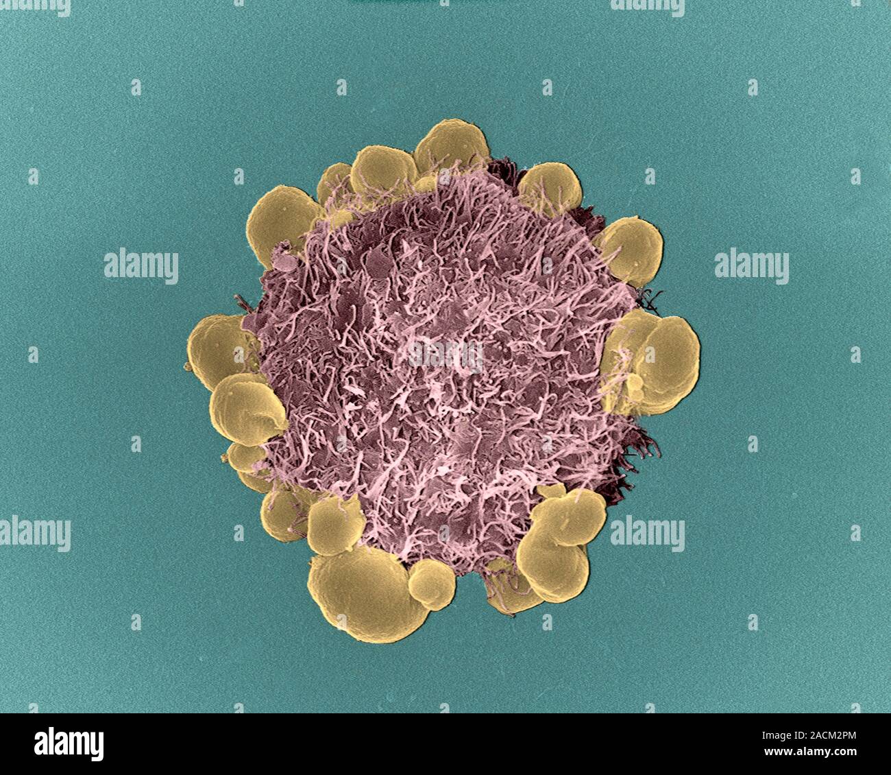 HeLa cell dying, coloured scanning electron micrograph (SEM). This cell ...