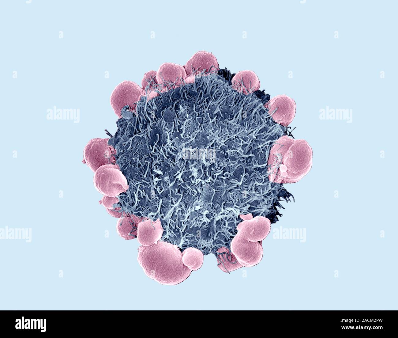 HeLa cell dying, coloured scanning electron micrograph (SEM). This cell ...