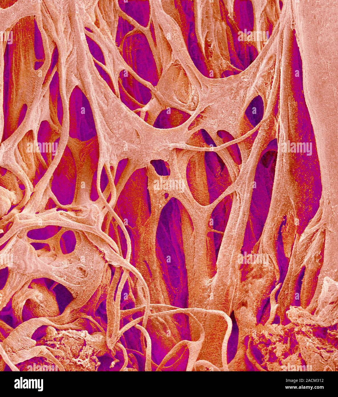 Trabeculae carneae in the left ventricle of the heart, coloured ...