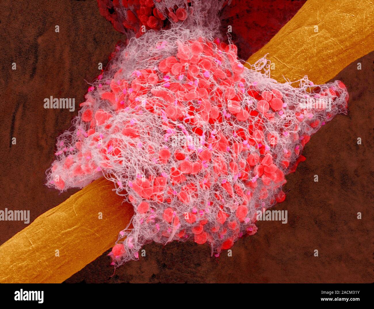 Blood clot. Coloured scanning electron micrograph (SEM) of a blood clot ...