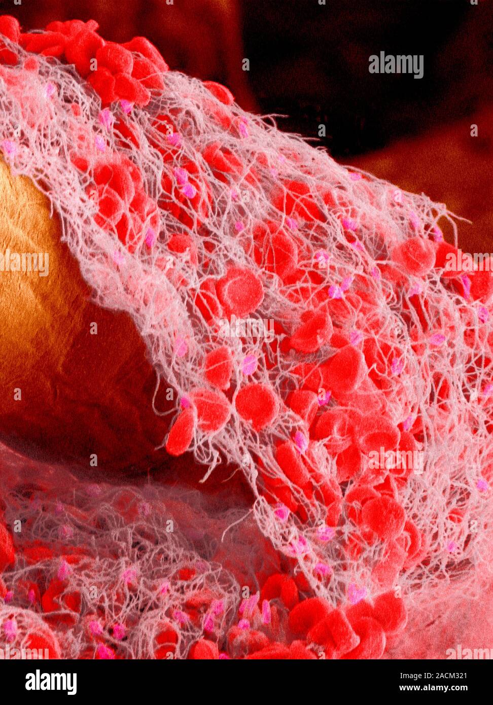 Blood clot. Coloured scanning electron micrograph (SEM) of a blood clot ...