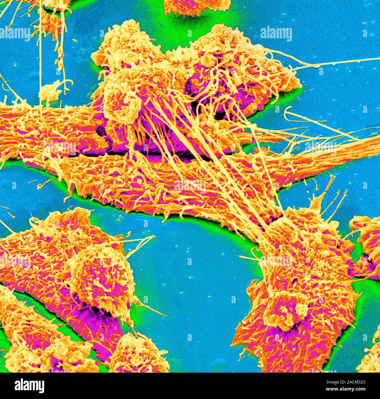 Cancer cells, coloured scanning electron micrograph (SEM). Cancerous ...