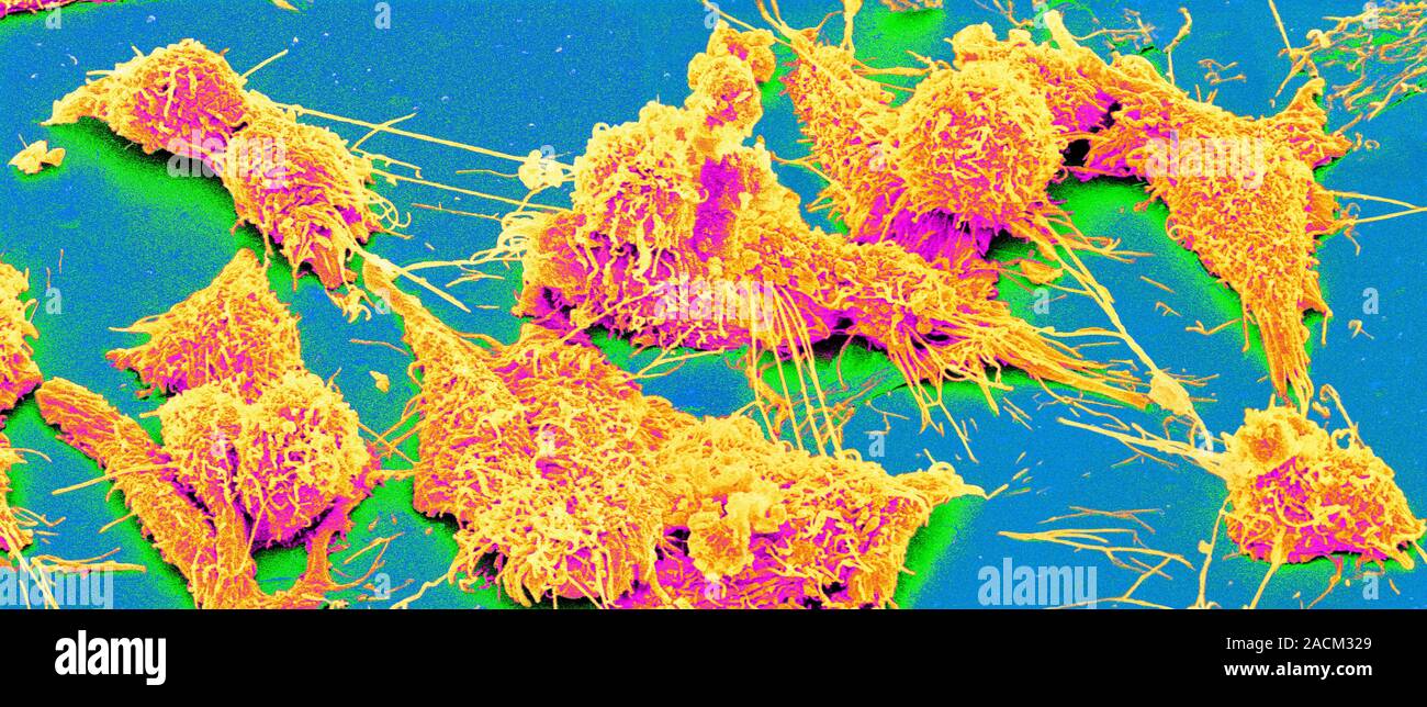 Cancer cells, coloured scanning electron micrograph (SEM). Cancerous ...