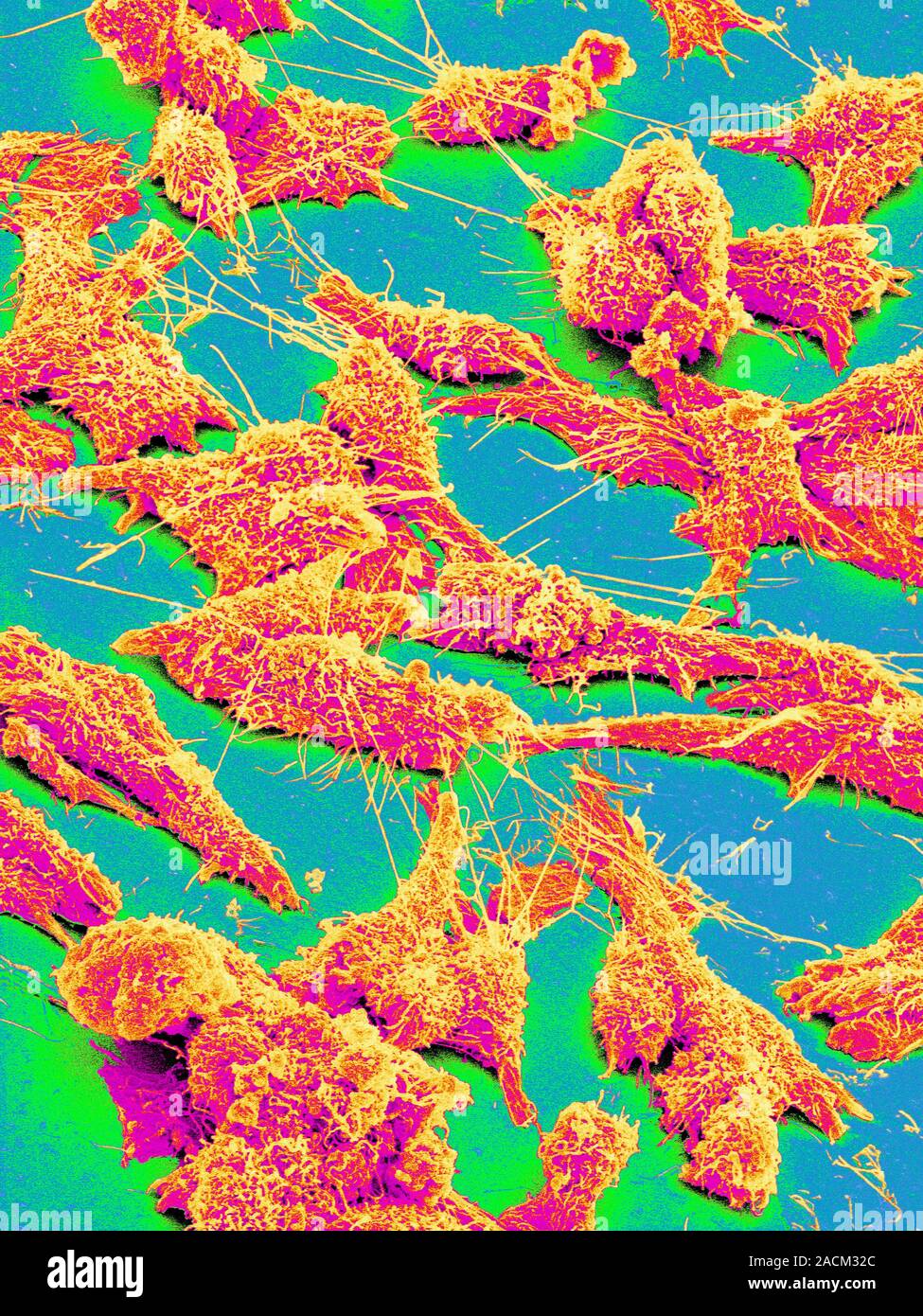 Cancer cells, coloured scanning electron micrograph (SEM). Cancerous ...