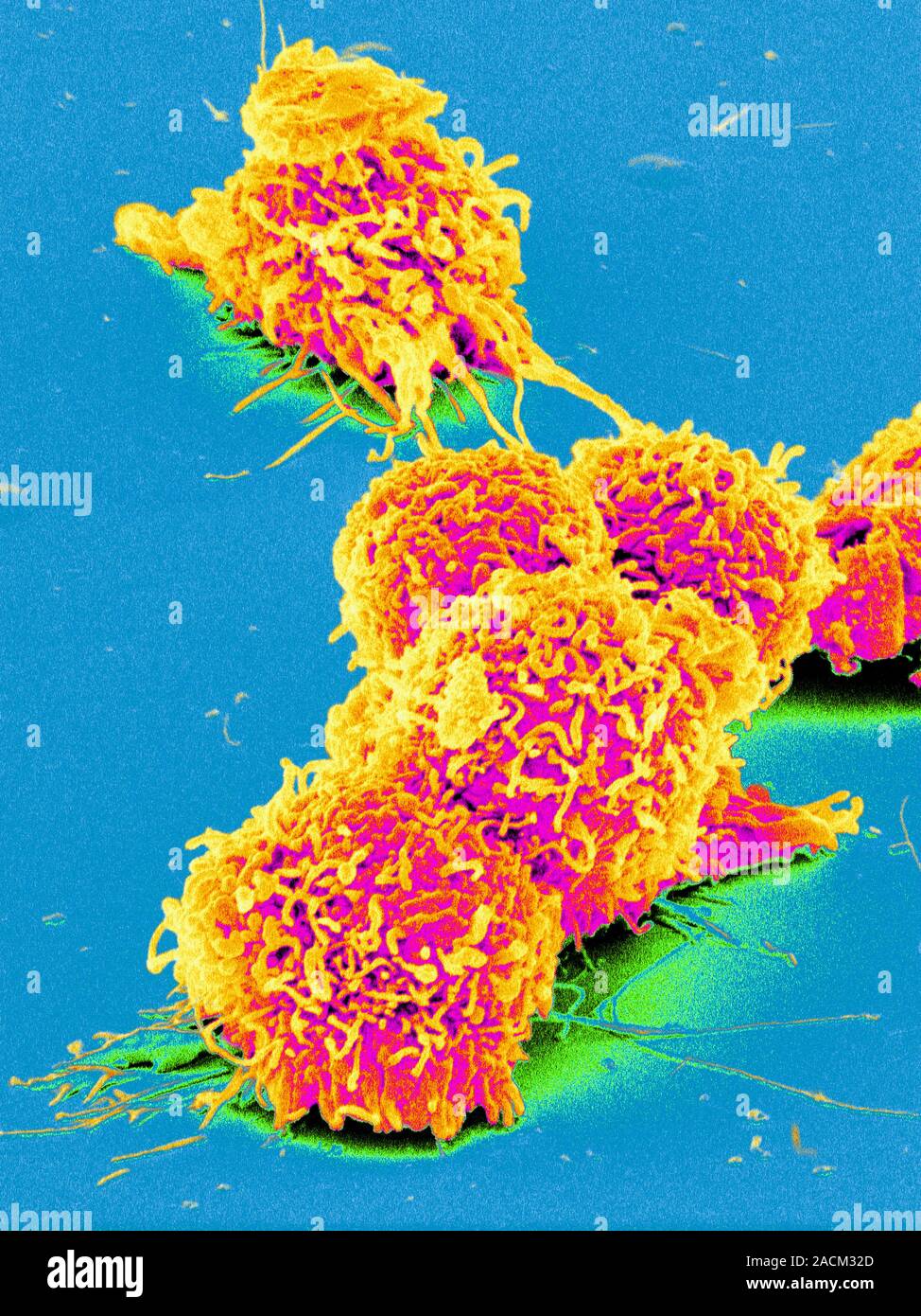 Cancer cells, coloured scanning electron micrograph (SEM). Cancerous ...