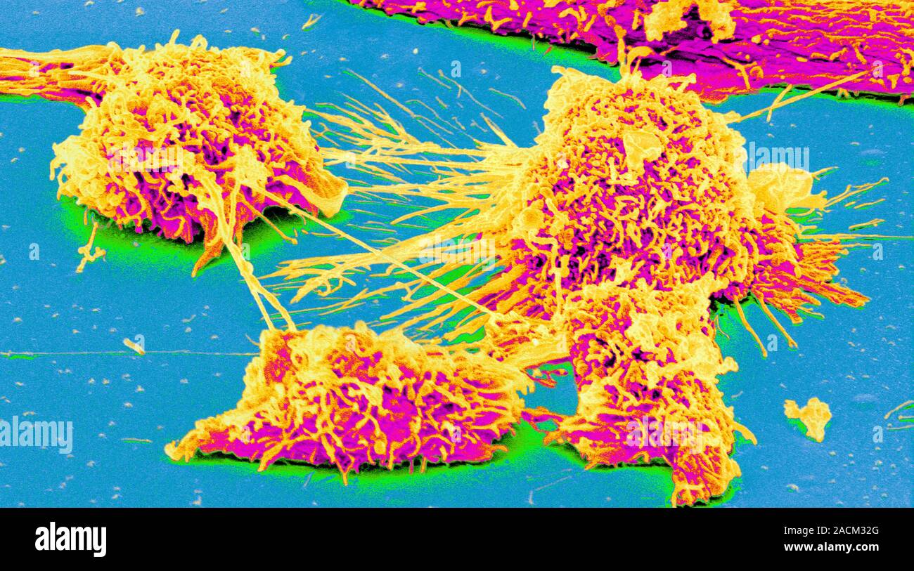 Cancer cells, coloured scanning electron micrograph (SEM). Cancerous ...