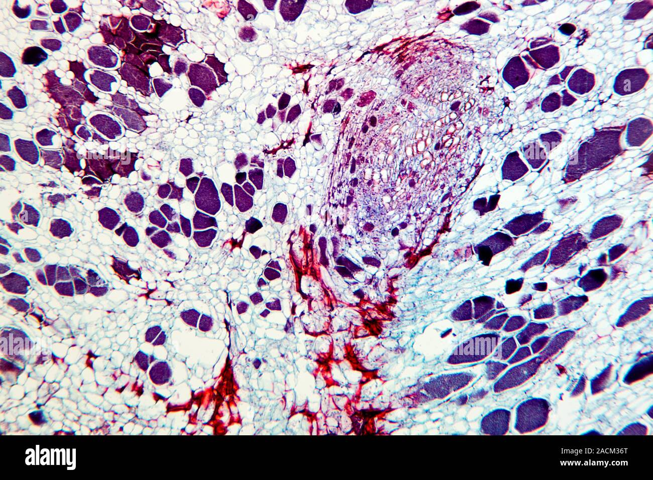 Clubroot infection. Light micrograph a section through a cabbage root infected with clubroot ...