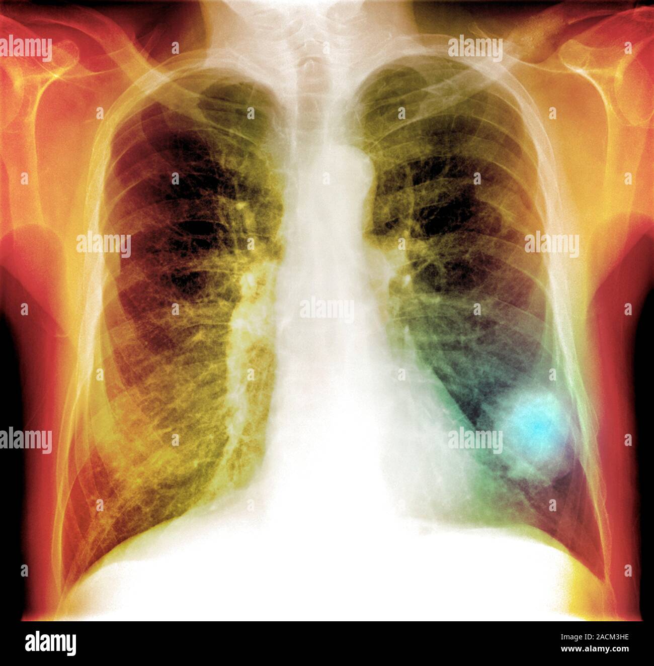 Lung cancer. Coloured chest X-ray of a 69 year old male patient with ...