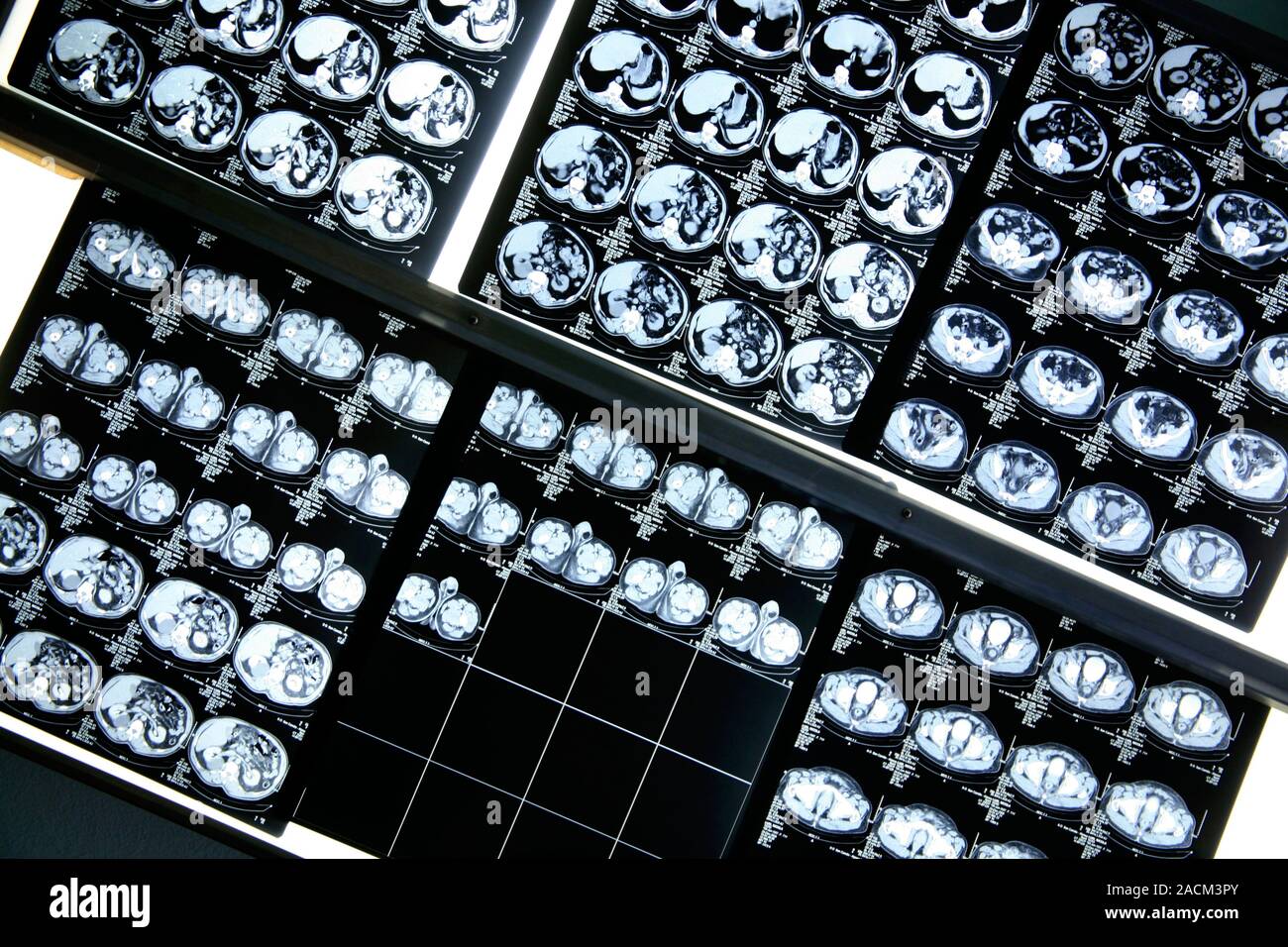 Lungs. Computed tomography (CT) scans of the lungs of a patient with ...