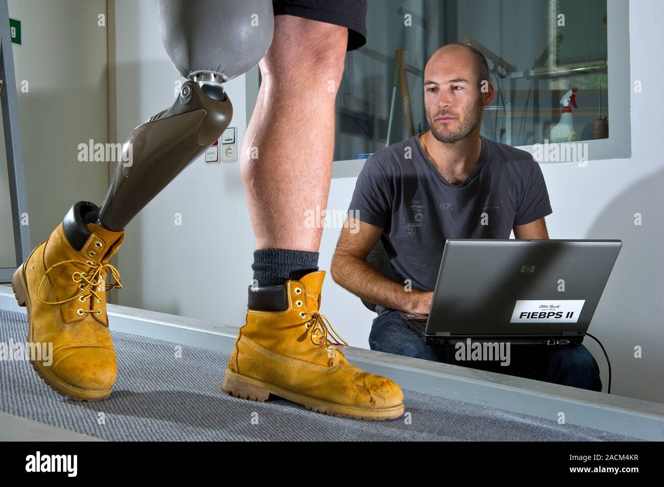 Genium prosthetic leg. Medical engineer assessing a patient who has a ...