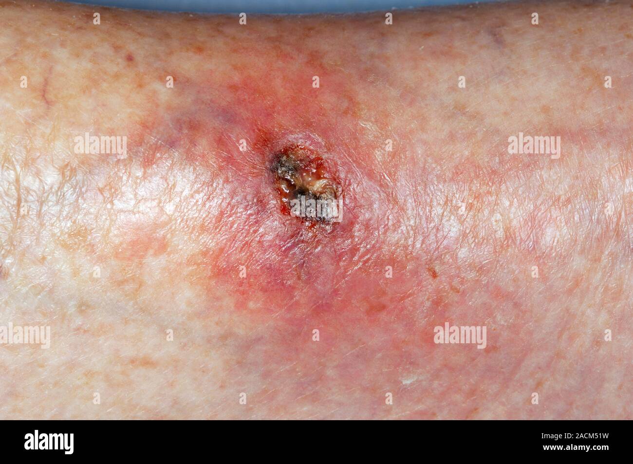 What Does An Infected Laceration Look Like