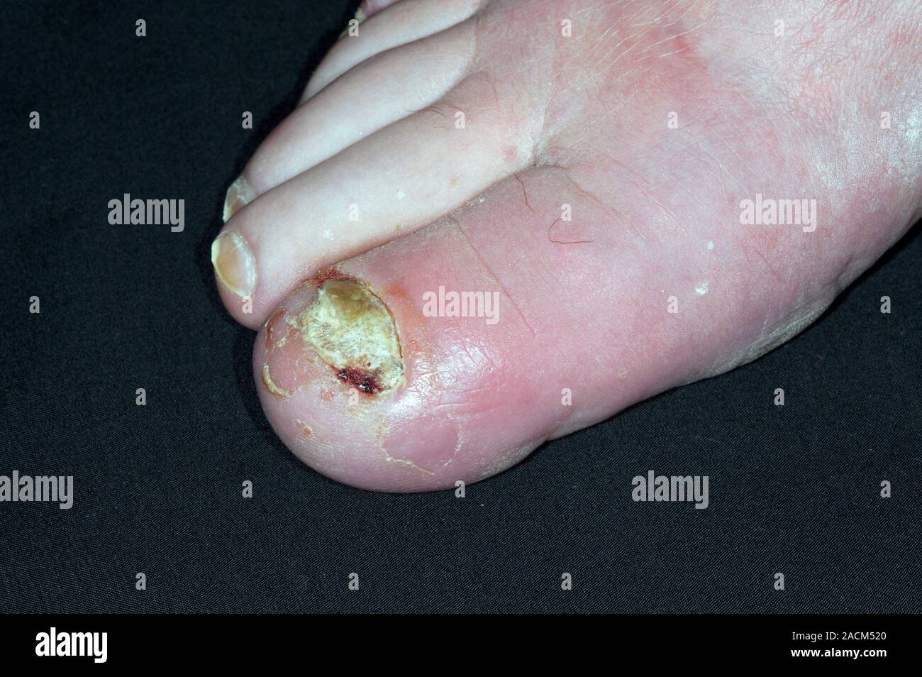 Red and inflamed big toe due to cellulitis in a 73 year old male ...