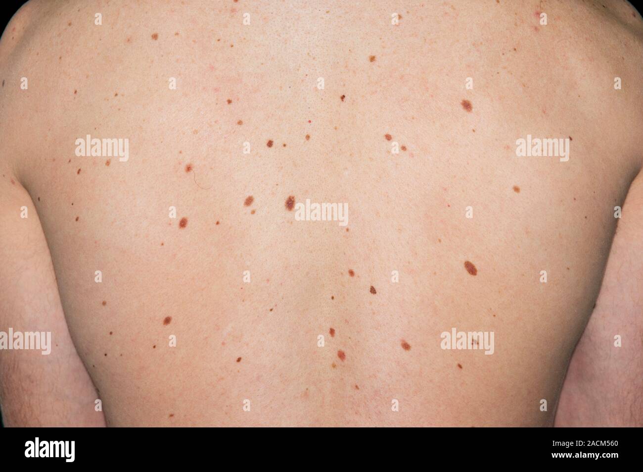 Moles (naevi) on the skin of the back in a 27 year old male patient. A ...