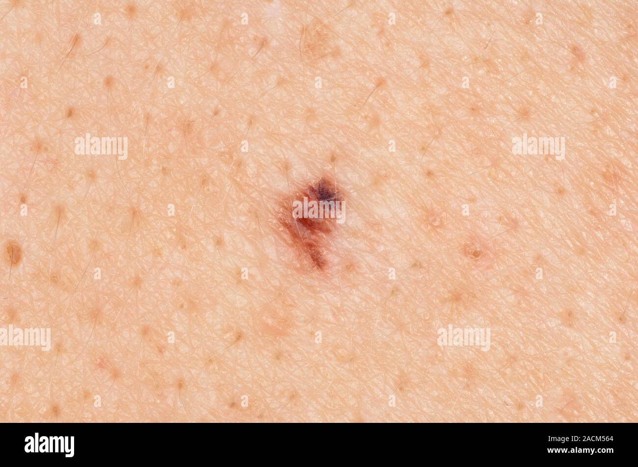 Junctional Naevus Mole On The Skin Stock Image C013 Junctional naevus ...
