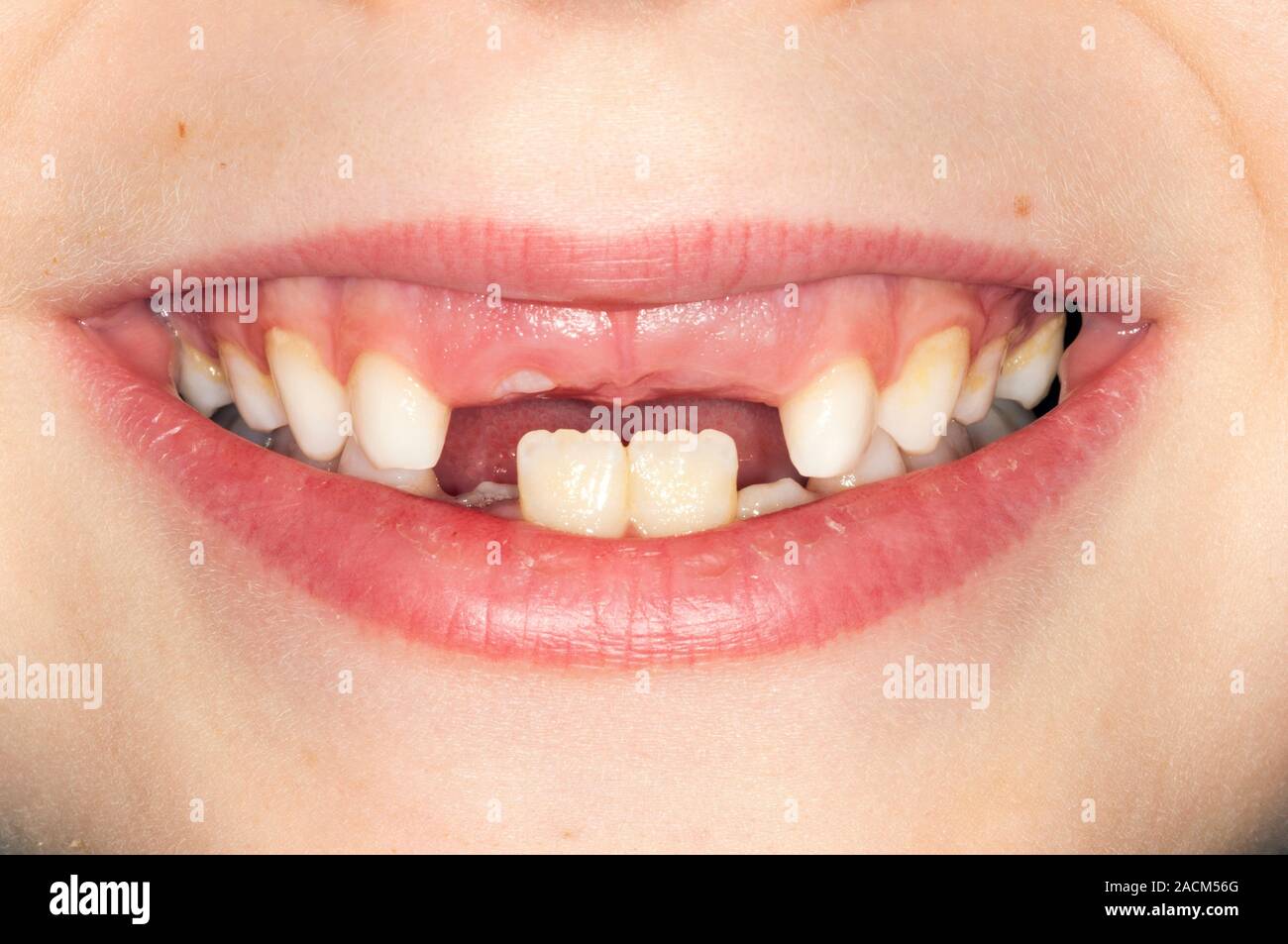 Normal loss of incisor teeth at the front of the mouth in a 7 year old ...