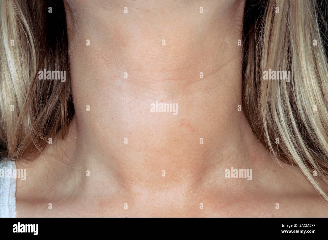 Goitre Swelling Of The Neck In A 21 Year Old Female Patient With