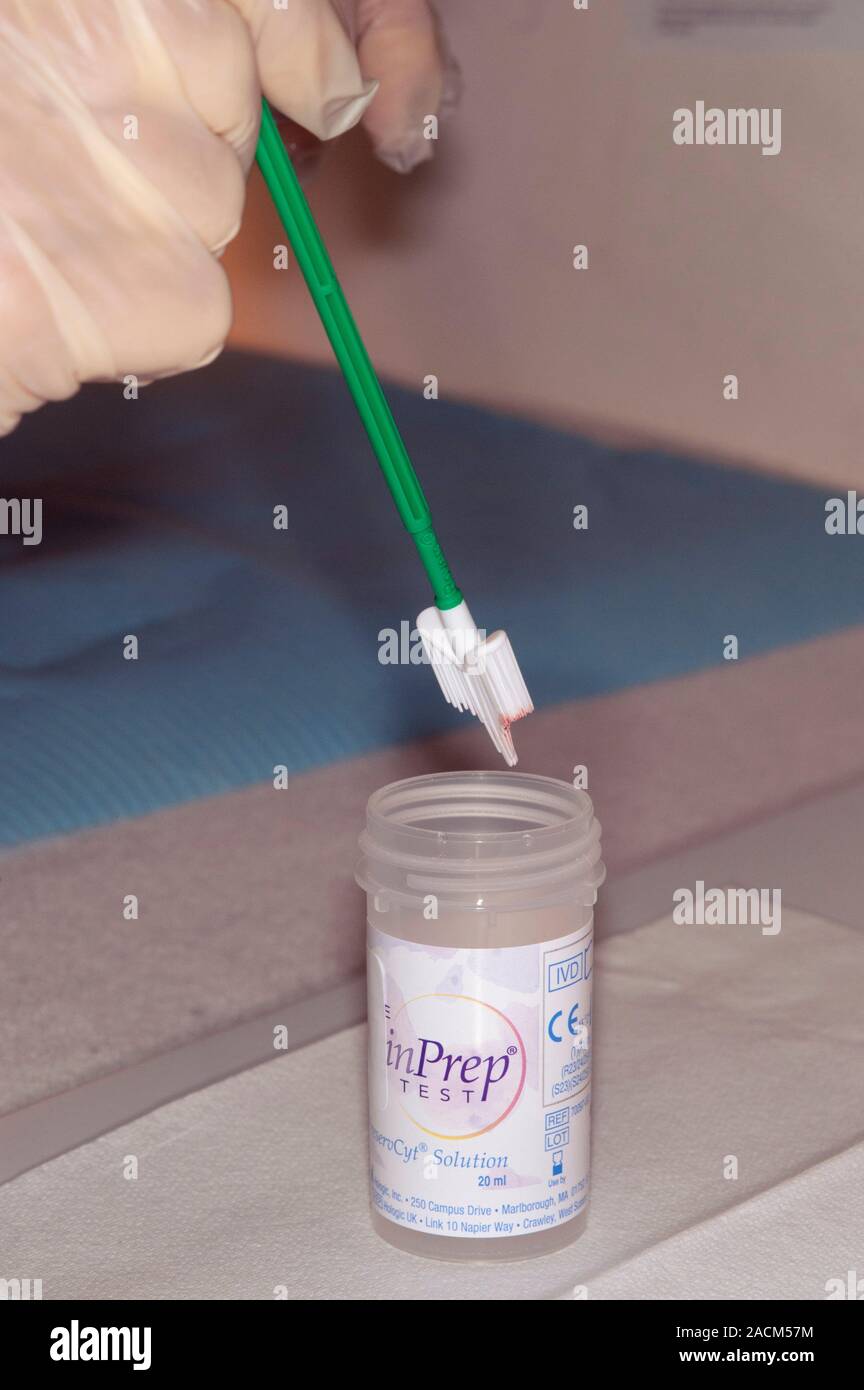 Gloved hand places a sample stick containing cervical cells into a ...