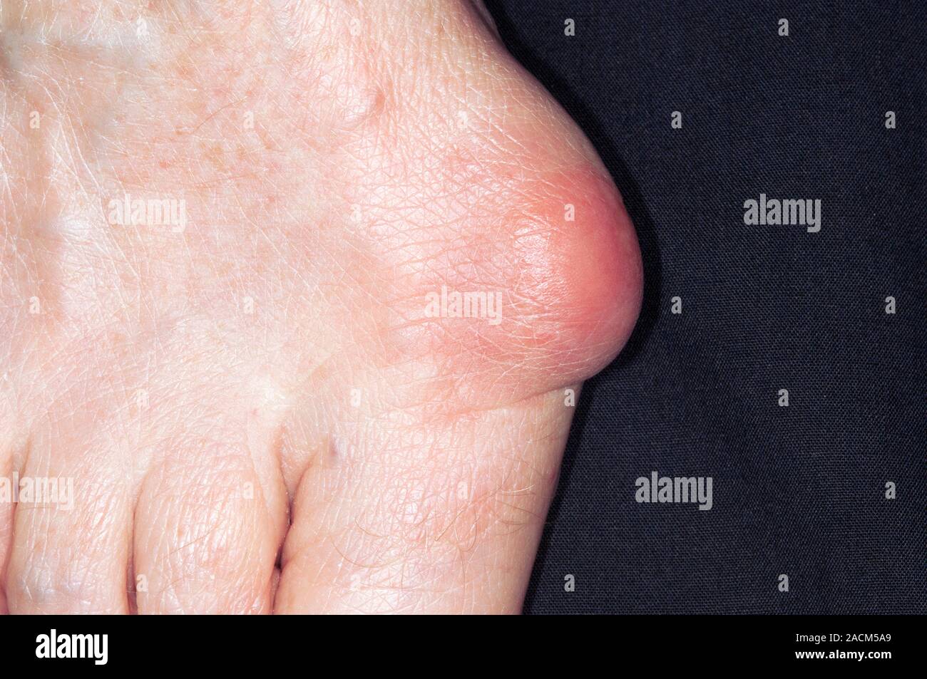 Red and inflamed bursa over a bunion (hallux valgus) in a 70 year old ...