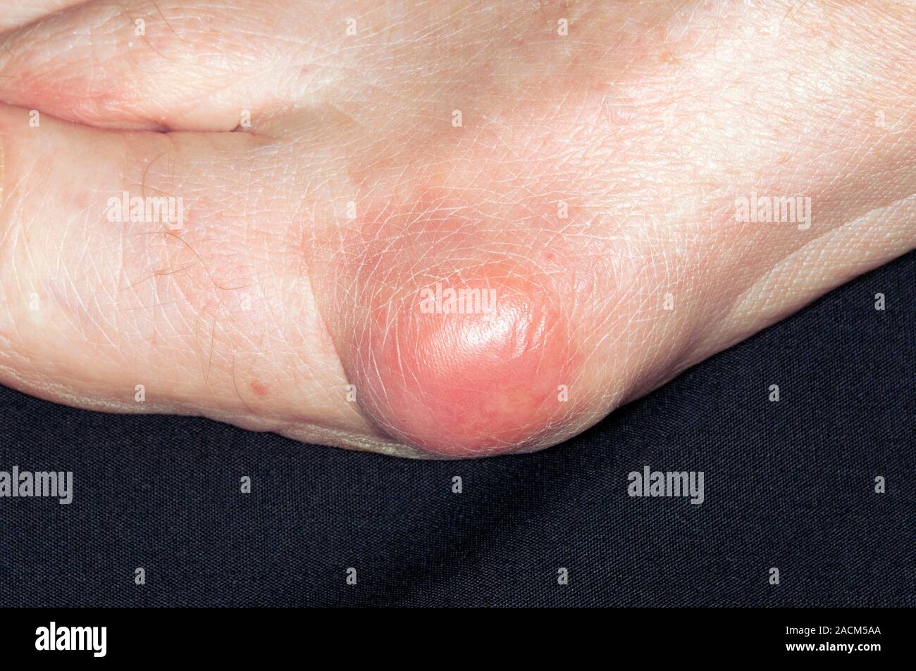 Red and inflamed bursa over a bunion (hallux valgus) in a 70 year old ...