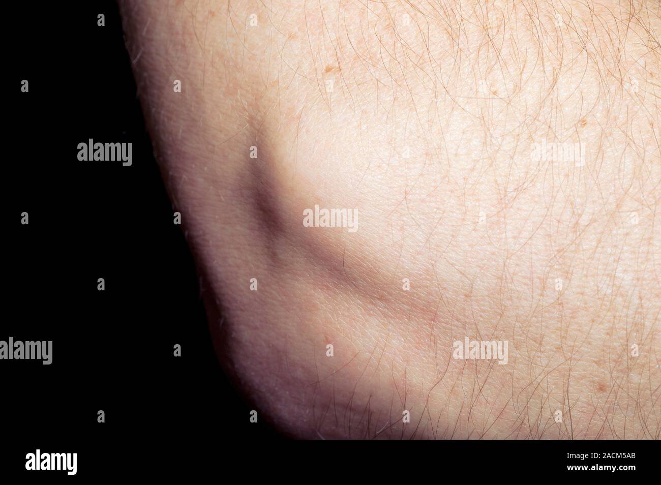 Swelling at the site of tennis elbow in a 54 year old male patient, a ...