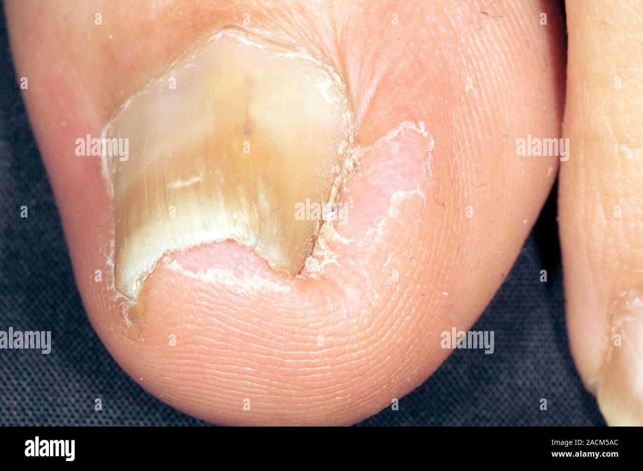 Ingrowing toenail of the big toe in a 59 year old male patient. The ...