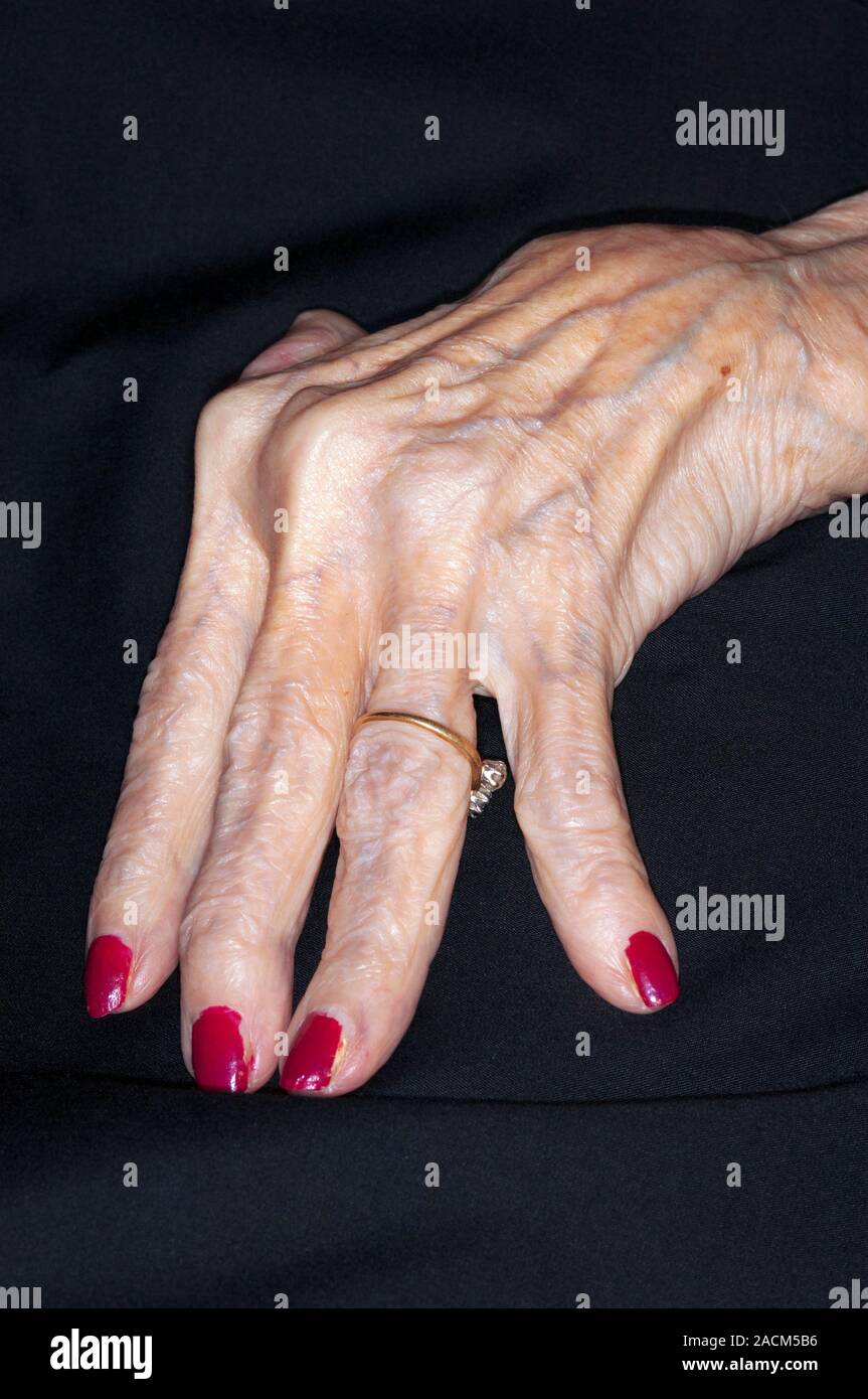 Close-up of deformed fingers the hand in a 90 year old female patient ...
