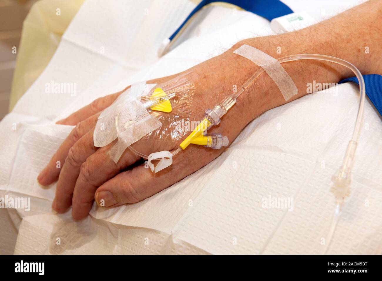Cannula inserted into a vein of the hand to administer an intravenous ...