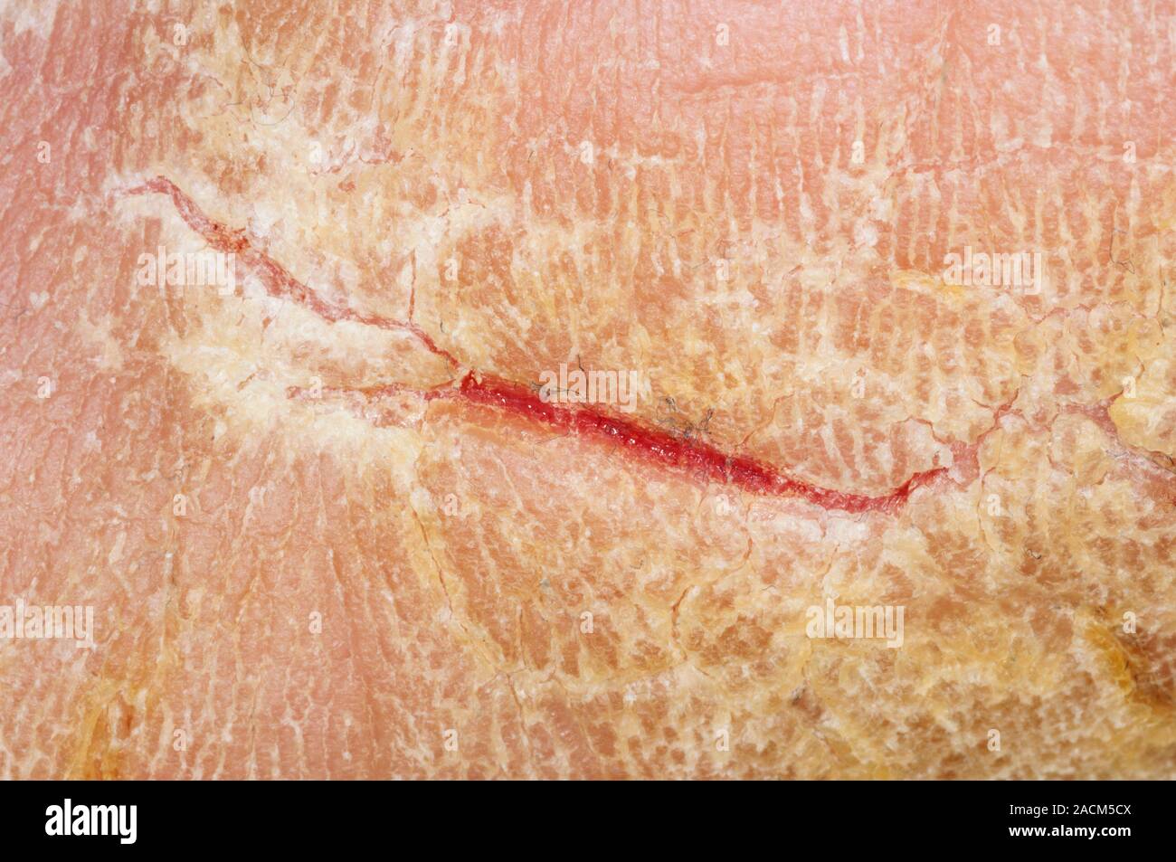 Close-up of a crack (fissure) in the sole of the foot in a 73 year old ...